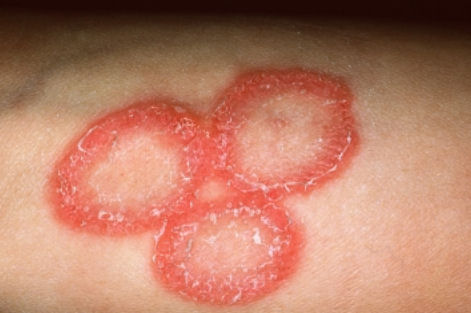 Tigna o tinea: tipi, trasmissione, sintomi, diagnosi, cura e ...