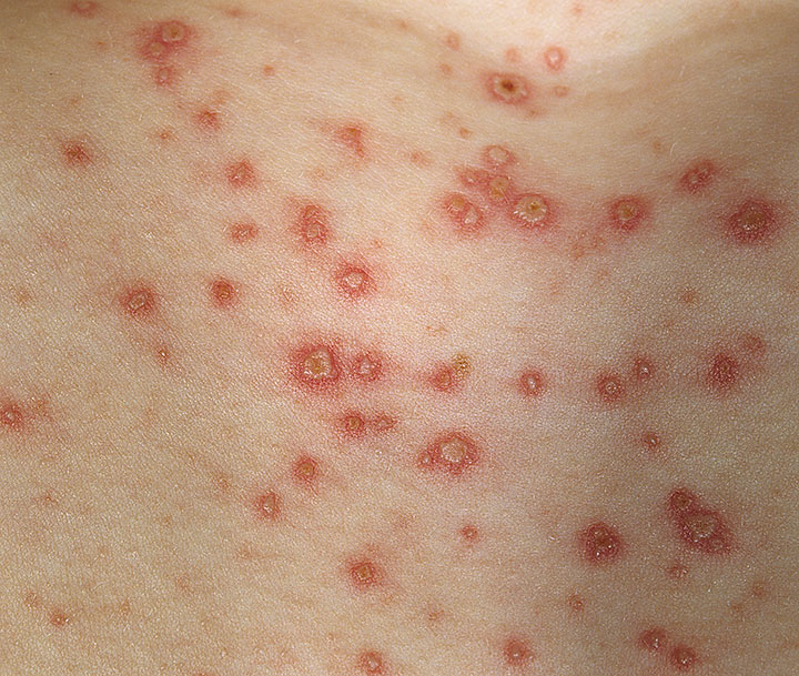 Varicella: cause, trasmissione, sintomi, diagnosi, cura e vaccinazione ...