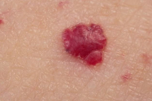 Angioma rubino: cause degli antiestetici “nei rossi”, pericolosità e ...