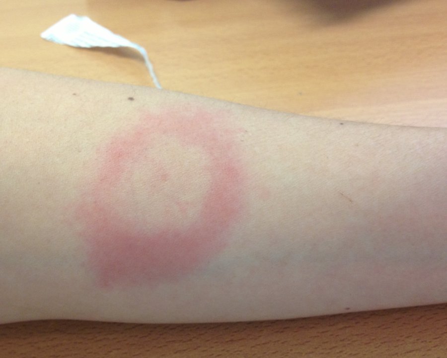 Il Morso di Zecca: Cosa Fare - Siciliafan